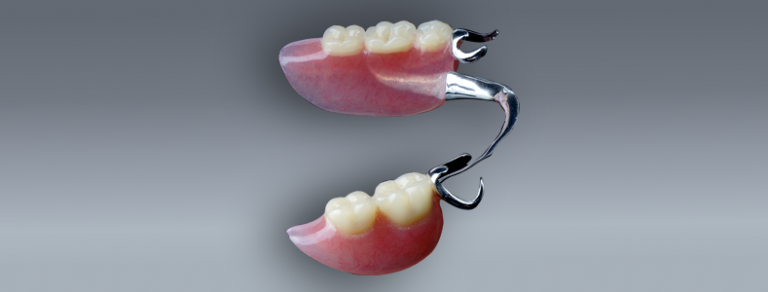 Removable Cast Partial Dentures | South Calgary Denture & Implant Clinic